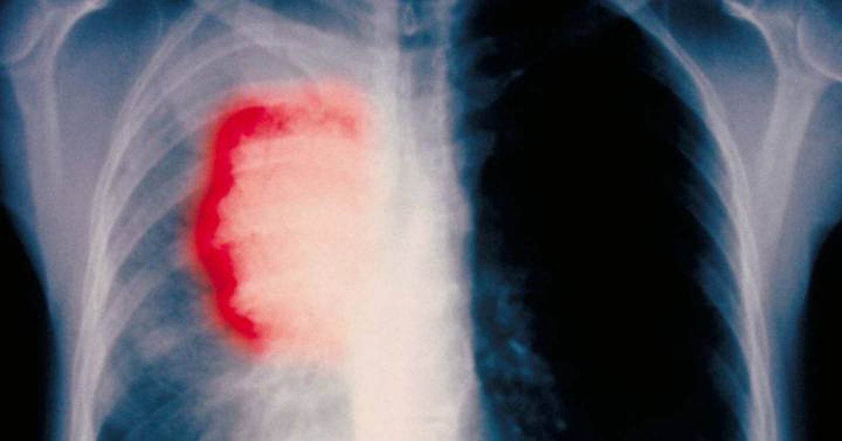 O segredo para frear o câncer que mais mata está no nariz | Ciência ...